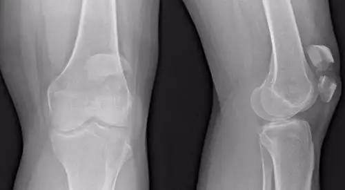 Fracturas de rótula | Síntomas y tratamiento | CUN