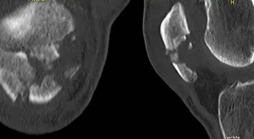 Fracturas de rótula | Síntomas y tratamiento | CUN