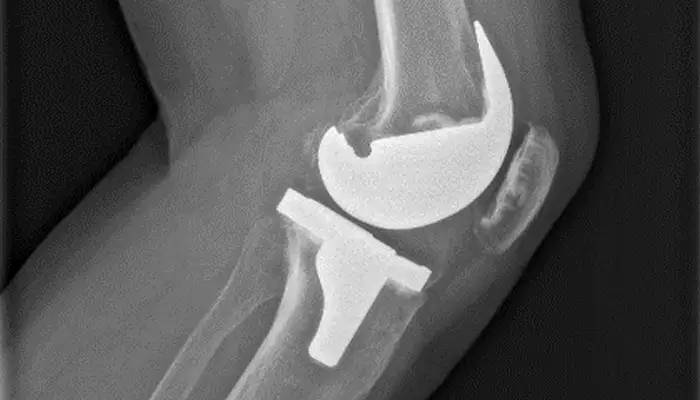 Artrosis de rodilla. Qué es, síntomas, diagnóstico y tratamiento ...