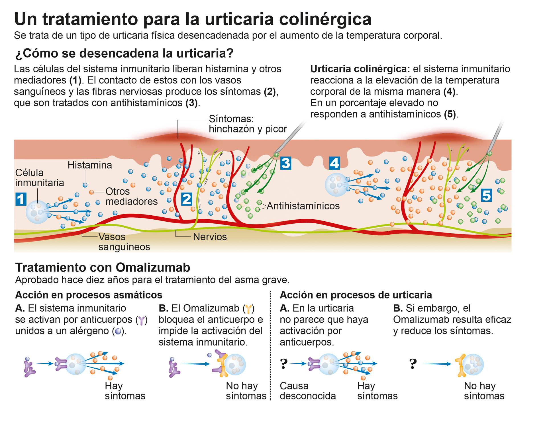 Infográfico Tratamiento Con Omalizumab De La Urticaria Colinérgica