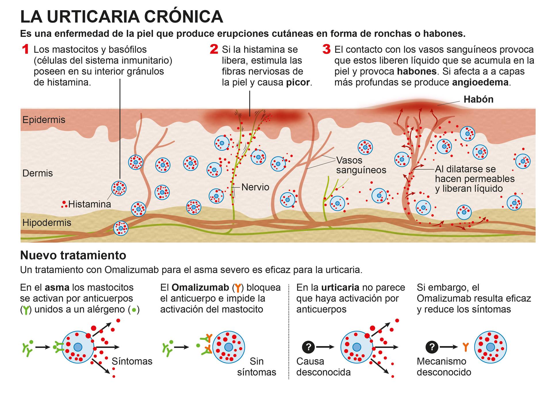 Infográfico Tratamiento Con Omalizumab De La Urticaria Crónica Clínica
