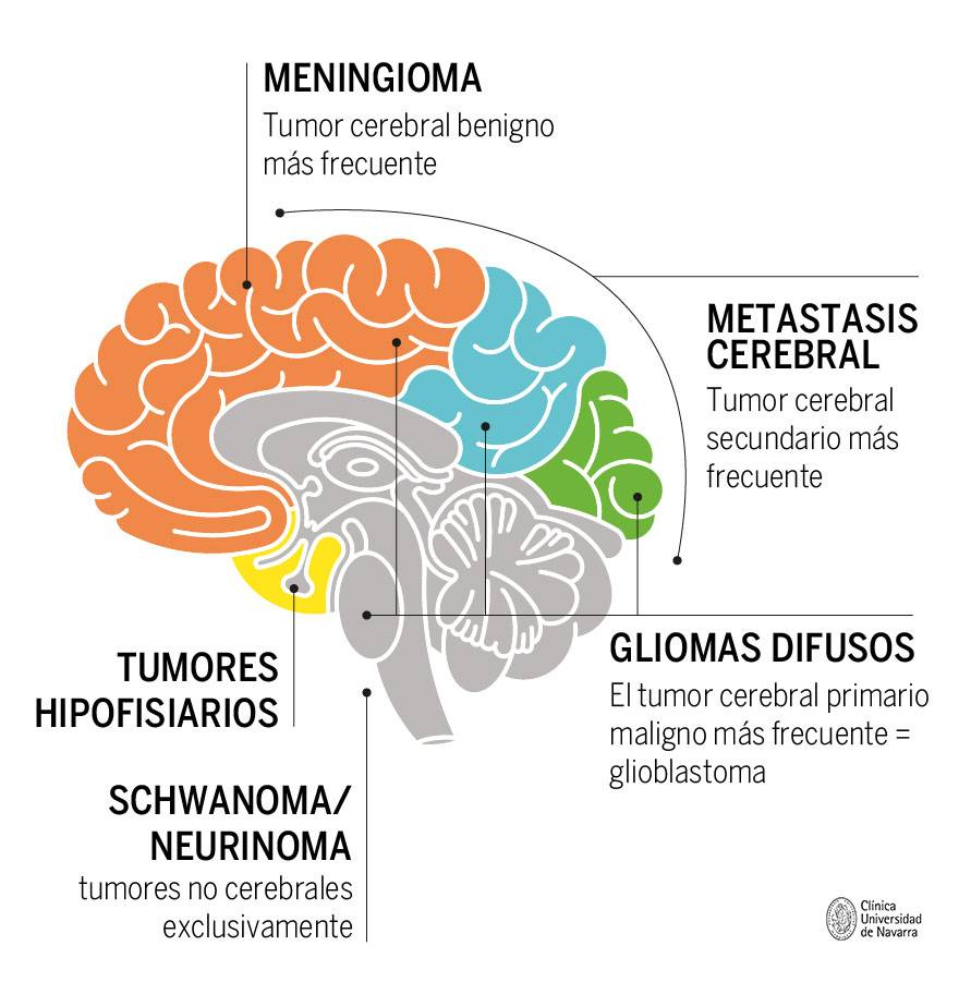 Tumor cerebral | Síntomas, diagnóstico y tratamiento | CUN
