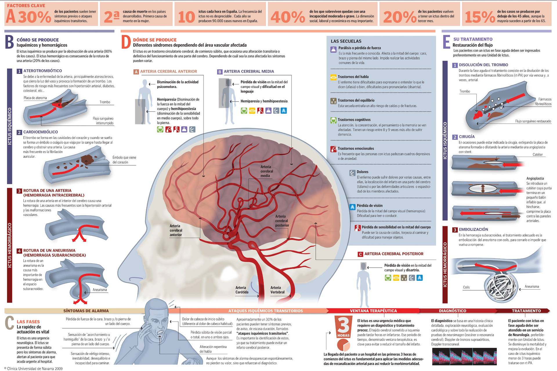 Infográfico Ictus O Acv Clínica Universidad De Navarra