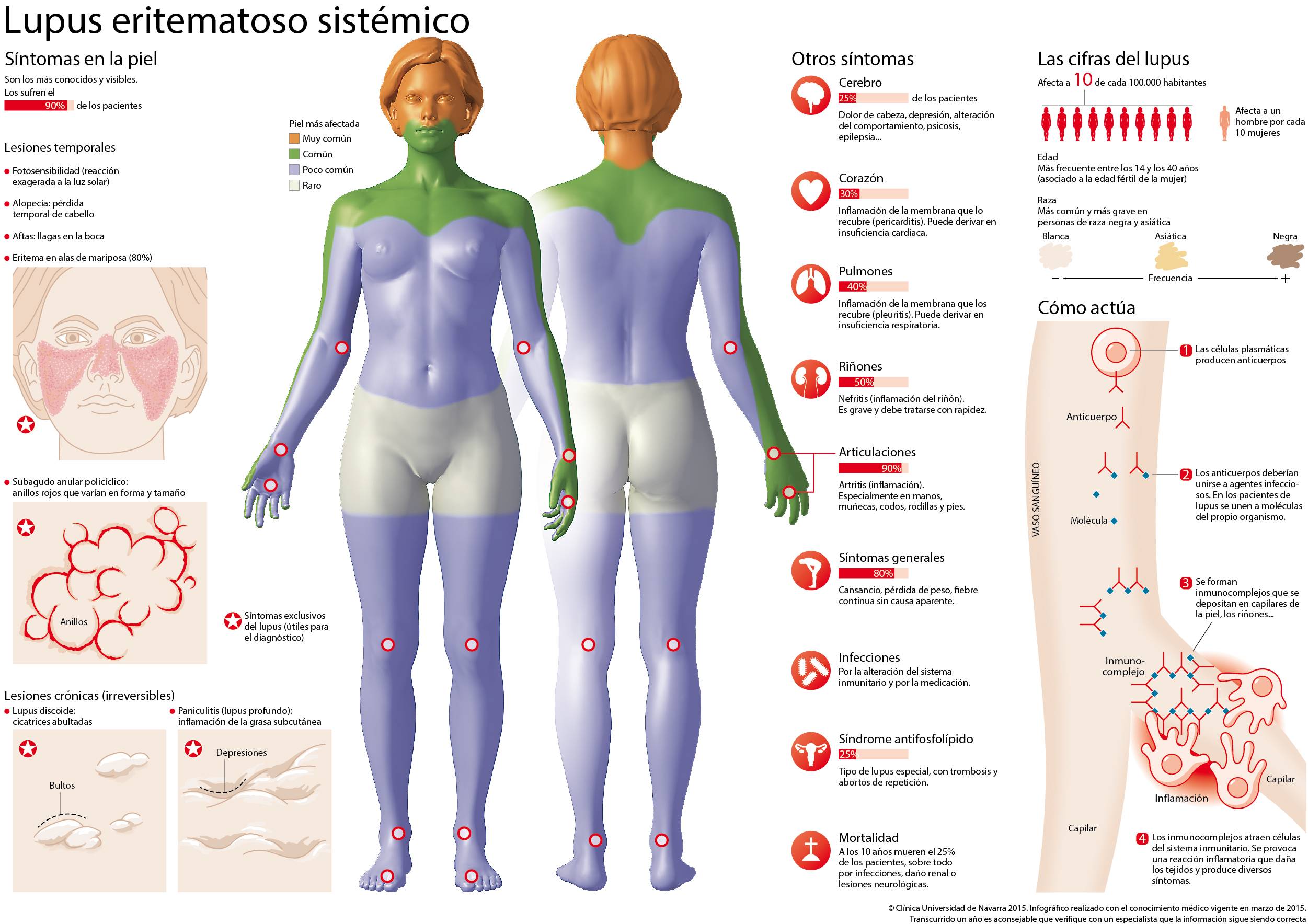 Que Es La Enfermedad Lupus Sintomas