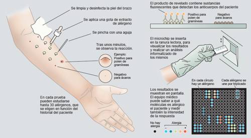 Diagnóstico por microarrays. Alergias. Clínica Universidad de Navarra