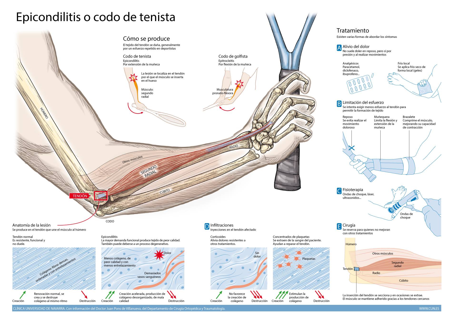 Dolor en codo. Epicondilitis. Codo del tenista. Causas, sintomas y ...