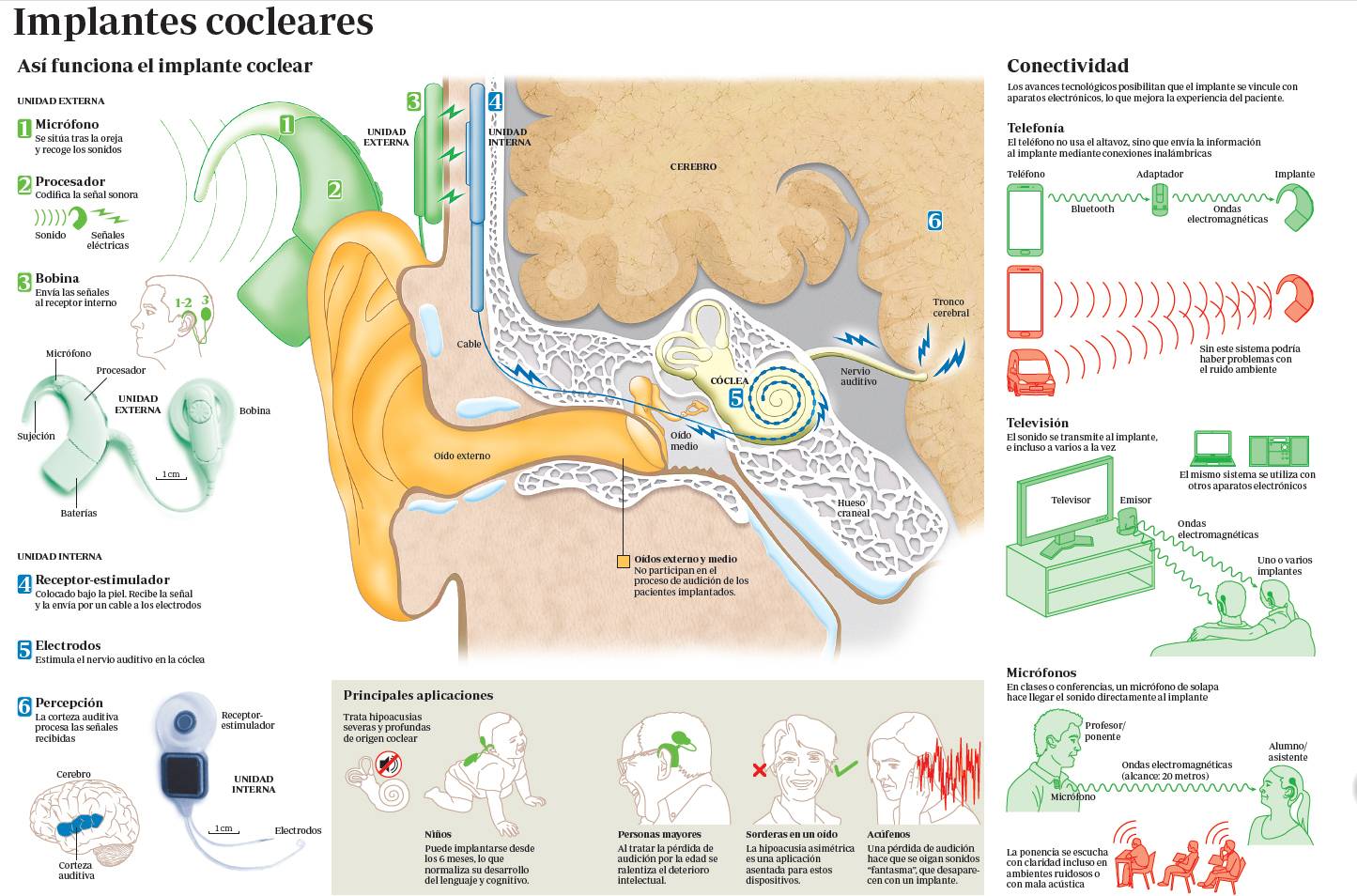 Cochlear implants. More information. Clínica Universidad de Navarra