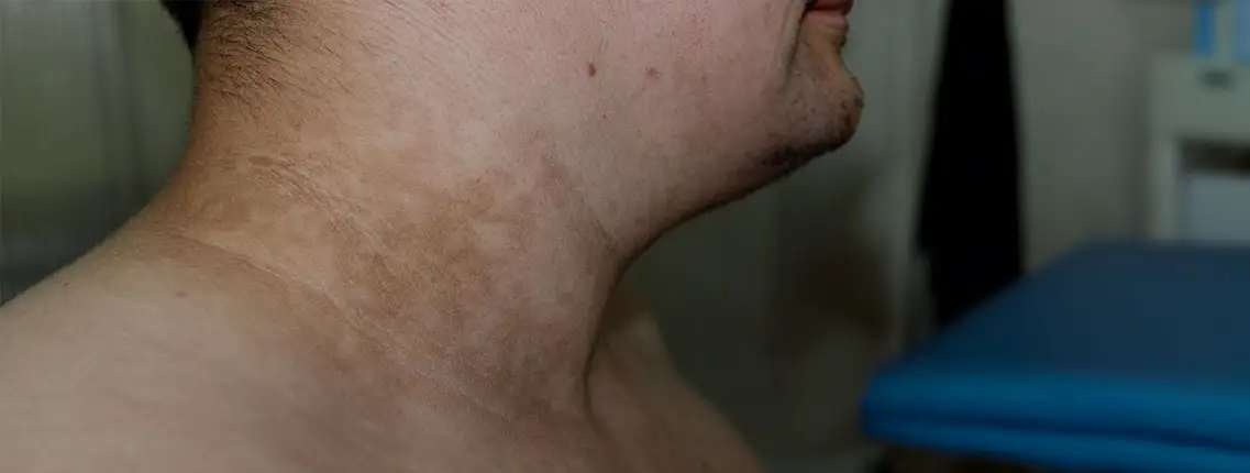 Mild Acanthosis Nigricans Neck