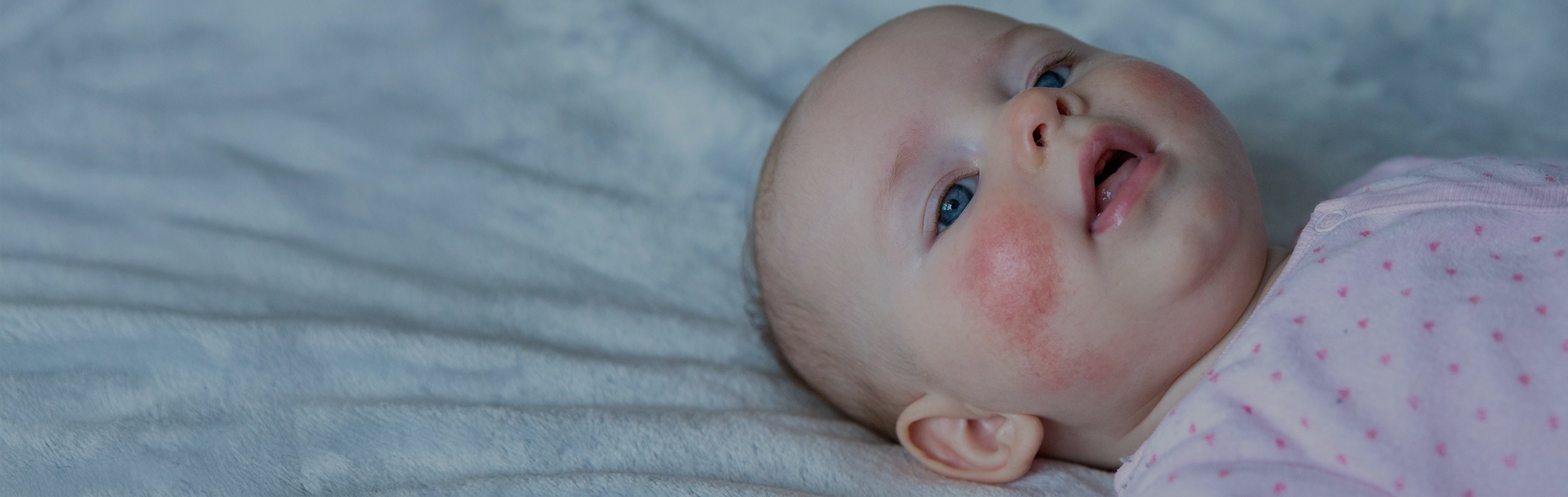 Eritema infeccioso: Síntomas, diagnóstico y tratamiento. Clínica ...