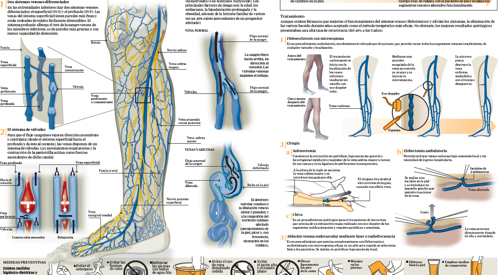 Varices. Insuficiencia venosa y linfática